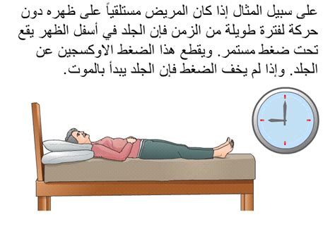 الوقاية من قرحات الإستلقاء