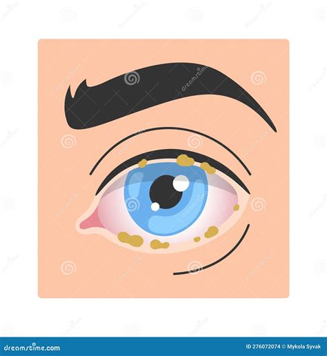 Blepharitis Human Eye Disease Stock Vector Illustration Of Eyeball Conjunctivitis 276072074