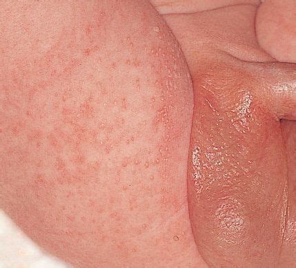 赤ちゃんの皮膚の病気 皮膚カンジダ症の症状とケア医師監修たまひよ