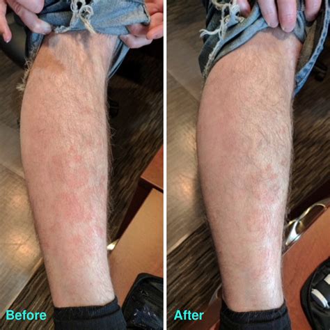 Collection 96 Pictures Red Rash On Lower Legs Above Ankles Photos Full