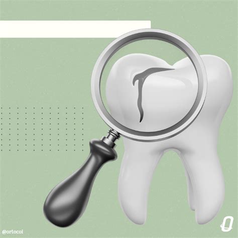 Manchas nos Dentes Cárie ou Outra Causa Ortocoi Clínica Ortodôntica