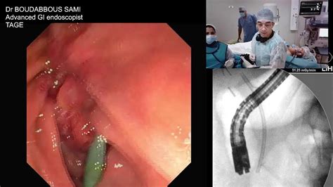 Ercp For Acute Cholangitis
