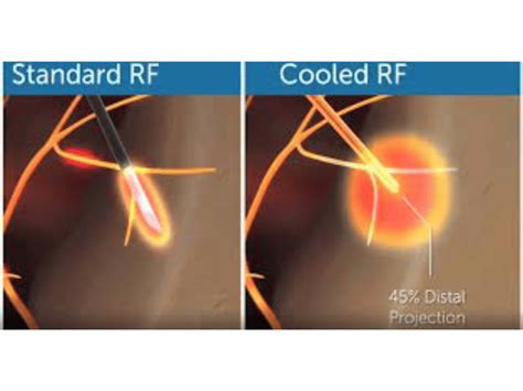 Cooled Radio Frequency Ablation For Knee Hip Pain Pune Dr Deshmukhs