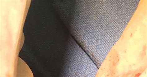 Proximal Row Carpectomy