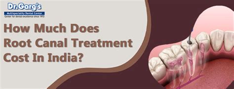 How Much Does Root Canal Treatment Cost In India Best Dental Clinic