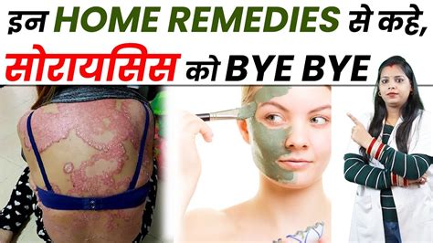 Natural Treatments And Home Remedies For Psoriasis Relief In Hindi Best
