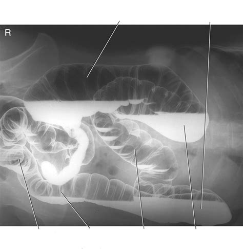 Left Lateral Decubitus Be Labeling Diagram Quizlet