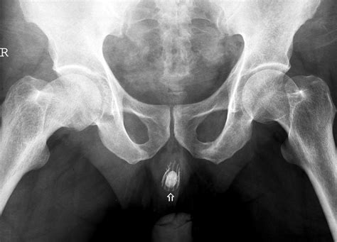 Anteroposterior View Of Plain X Ray Pelvis Showing Impacted Calculus