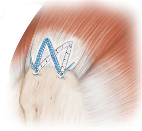 Rotator Cuff Dr Yves Depaepe