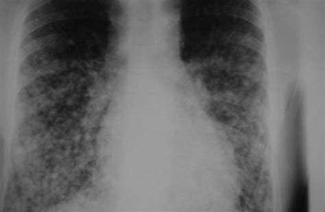 Chest X Ray Shows Multiple Miliary Mottling Download Scientific Diagram