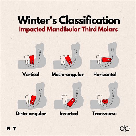 📚👉🏼 Winters Classification Impacted Odontology Student