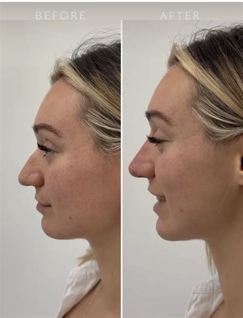 Nose Filler Before And After — Dr Senna Clinic Luxury Aesthetic Clinic In Barnes Anti