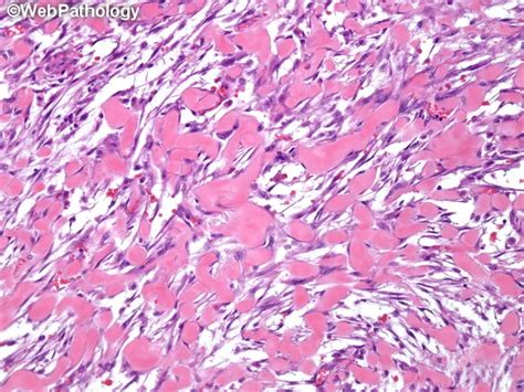 Nodular Fasciitis