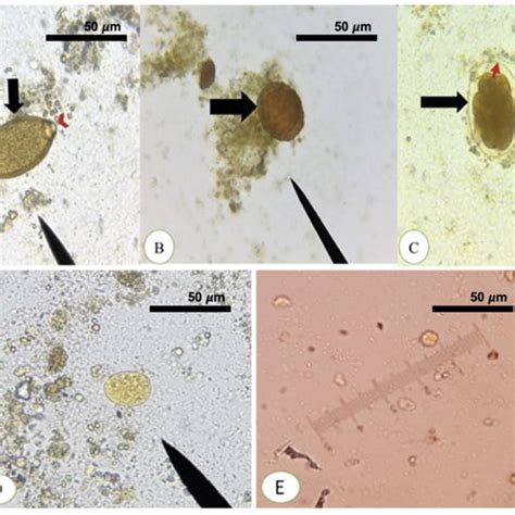 Colonoscopy Showing Whitish Worms Trichuris Trichiura In The Colon