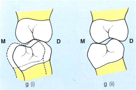 11 Occlusal Adjustment And Equilibration Pocket Dentistry