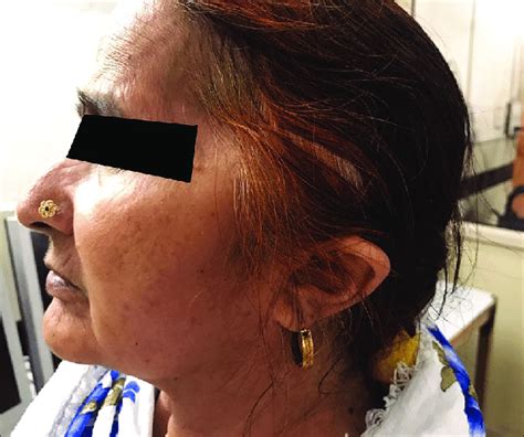 Clinical Photograph Of The Patient Showing Fullness And Swelling In The