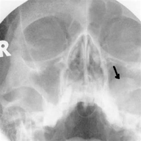 Technetium 99 Bone Scan Revealed Increased Uptake In Both Maxillae