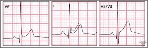 Early Repolarization Ecg Stampede