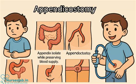 Appendicostomy Mace Procedure