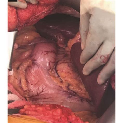 A Endoscopic Image Normal Duodenum B C Upper Gastrointestinal Download Scientific