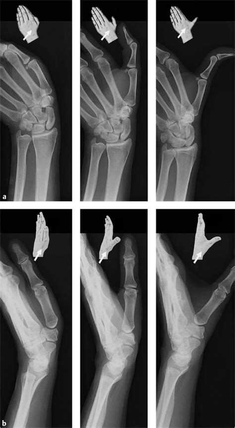 Intra Articular Fractures At The Base Of The First Metacarpal Musculoskeletal Key