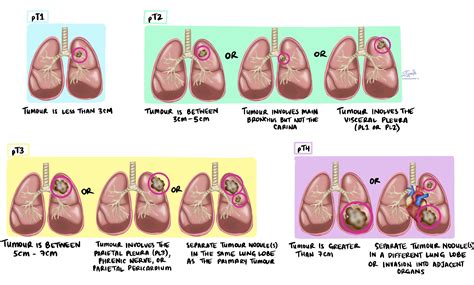 Adenosquamous Carcinoma Of The Lung Mypathologyreport