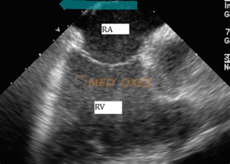 Cardiac Structures In Intracardiac Echocardiography Medfoxes