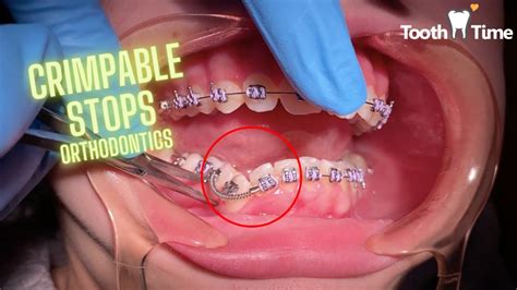 What Are Coil Springs Used For On Braces At Martha Brugger Blog