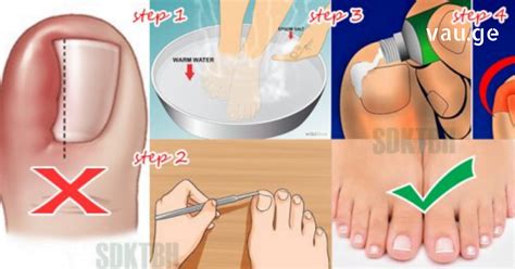 ნახეთ რა მარტივია ჩაზრდილი ფრჩხილის მკურნალობა ქირურგიული ჩარევების გარეშე Vau Ge