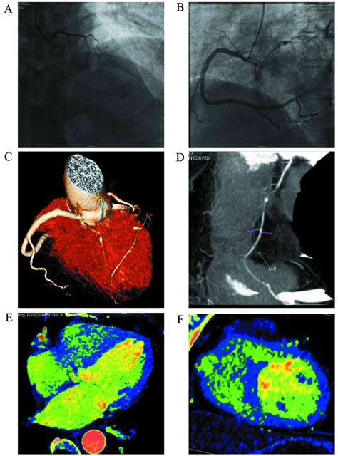 Diagnostic Accuracy Of Coronary CT Angiography Combined With Dual