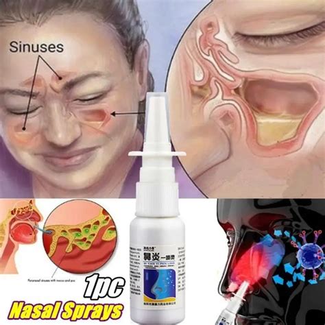 Традиционный медицинский травяной спрей для ухода за носом для лечения хронического ринита