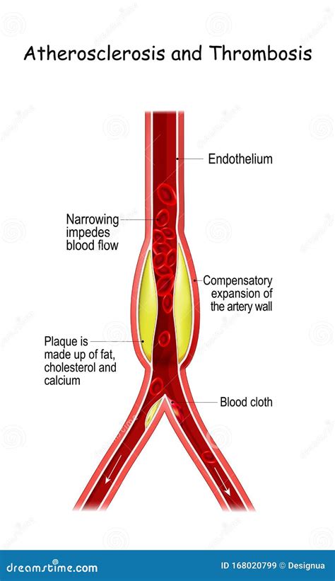 Atherosclerosis And Thrombosis Stock Vector Illustration Of Health