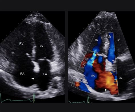 Ecocardiograma De Insuficiencia Cardiaca