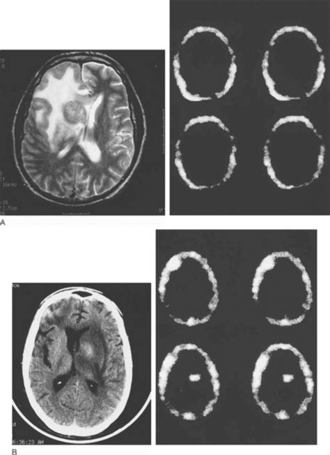 Toxoplasmosis Oncohema Key