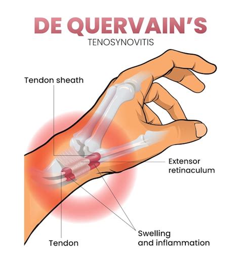 De Quervain Syndrome