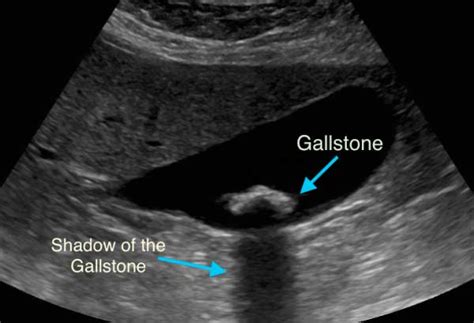 Gallstones Ultrasound Gallstone Cholelithiasis Imaging Practice