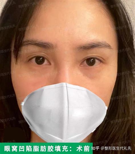 医生科普：眼窝凹陷脂肪胶填充后，多久能恢复自然？ 知乎