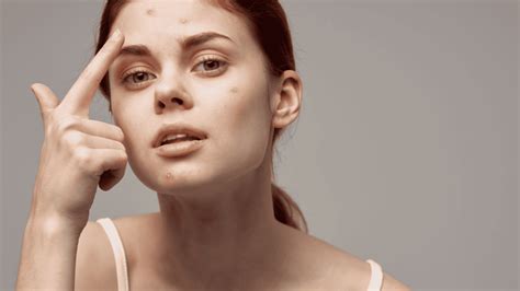 The Best Natural Ingredients To Treat Acne Prone Skin A Green Beauty