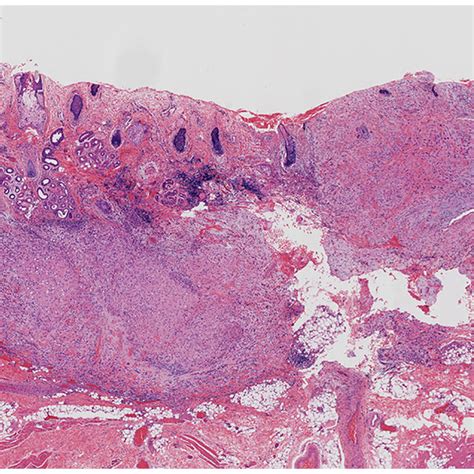 Nodular And Solid Patchy Growth Of The Tumor In The Dermis And