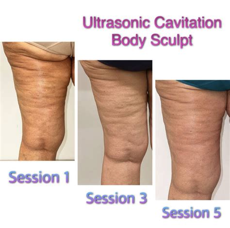 Cavitation Amanda T Therapy