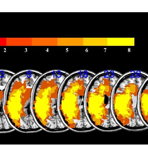 Lesion Overlap Map For 29 Patients With Psa To Illustrate The Download Scientific Diagram