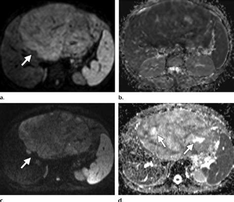 Response To Therapy Administered To A 19 Year Old Man Who Presented