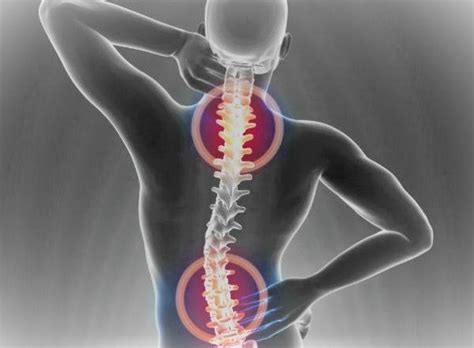 Тренировки при сколиозе Тренировки Сколиоз Бодибилдинг