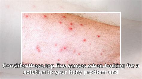 Big Red Bumps On Legs That Itch Junkieslily
