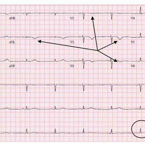 12 Lead Electrocardiogram Showing T Wave Inversions In The Anterior