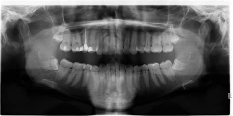 Help Need Help With My X Ray Left Ear And Jaw Muscle Pain And Tender