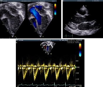 Basic Course In Pediatric Heart Failure And Heart Transplantation Niakoro