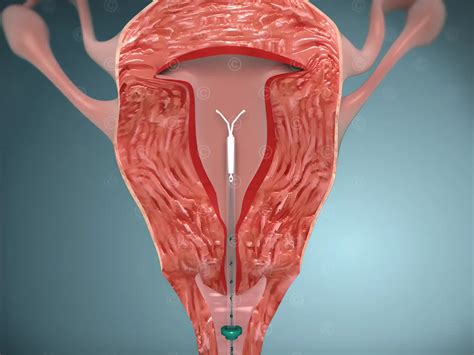 Animation Contraceptive Loop Medicalgraphics