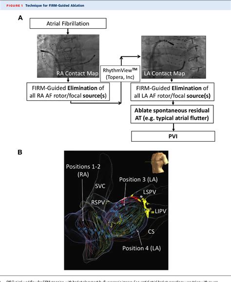 Figure 1 From Recurrent Post Ablation Paroxysmal Atrial Fibrillation Shares Substrates With