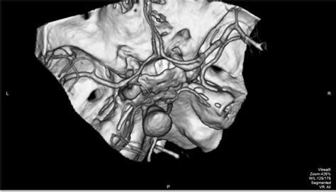Brain Ct Angiography Giant Posterior Cerebral Artery Pca Aneurysm Download Scientific Diagram